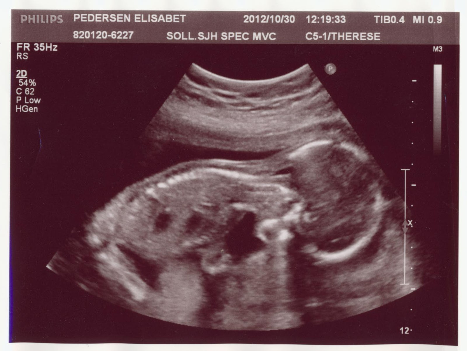 SILVERBLINK: Ultraljud:)