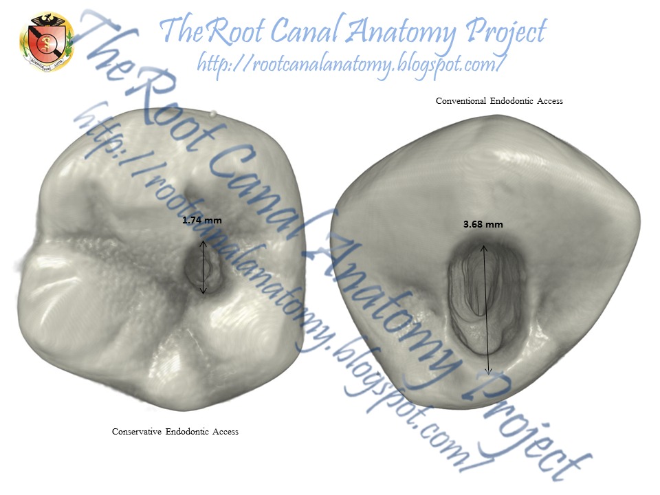The Root Canal Anatomy Project: Conservative Endodontic Access ...