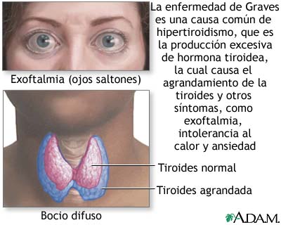 ~Hasta La Vista~: Enfermedades de la Tiroides