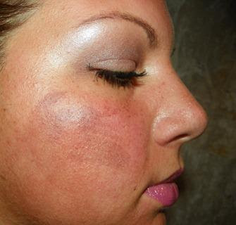 Home Remedies For Minor Burn On Face ~ Health And Beauty Tips