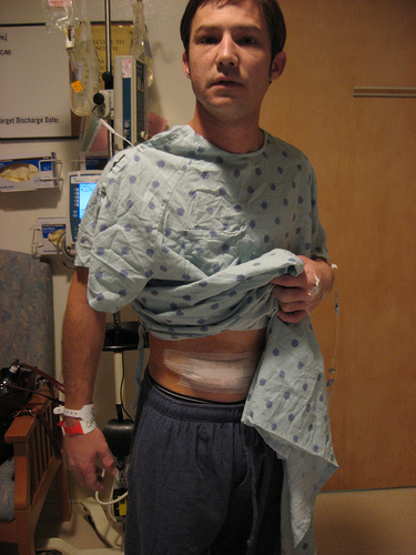 Colostomy Stoma: Stoma