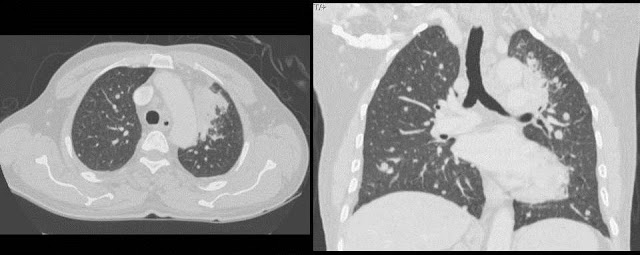 Radshare: CEREBRAL METASTASIS- MULTIPLE RING ENHANCING LESIONS