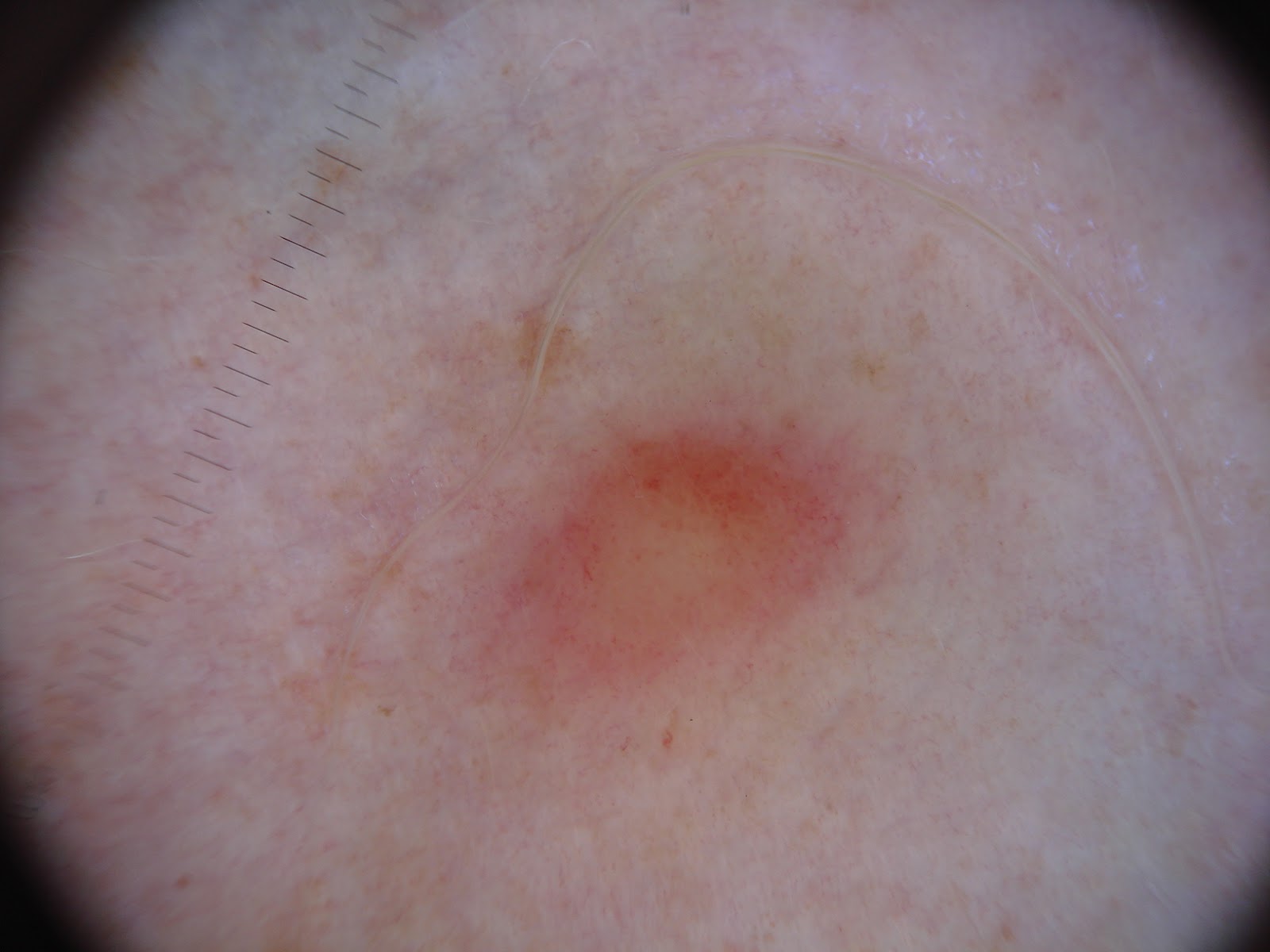 Consultations in Dermatoscopy: Ian McColl - Pink and Purple