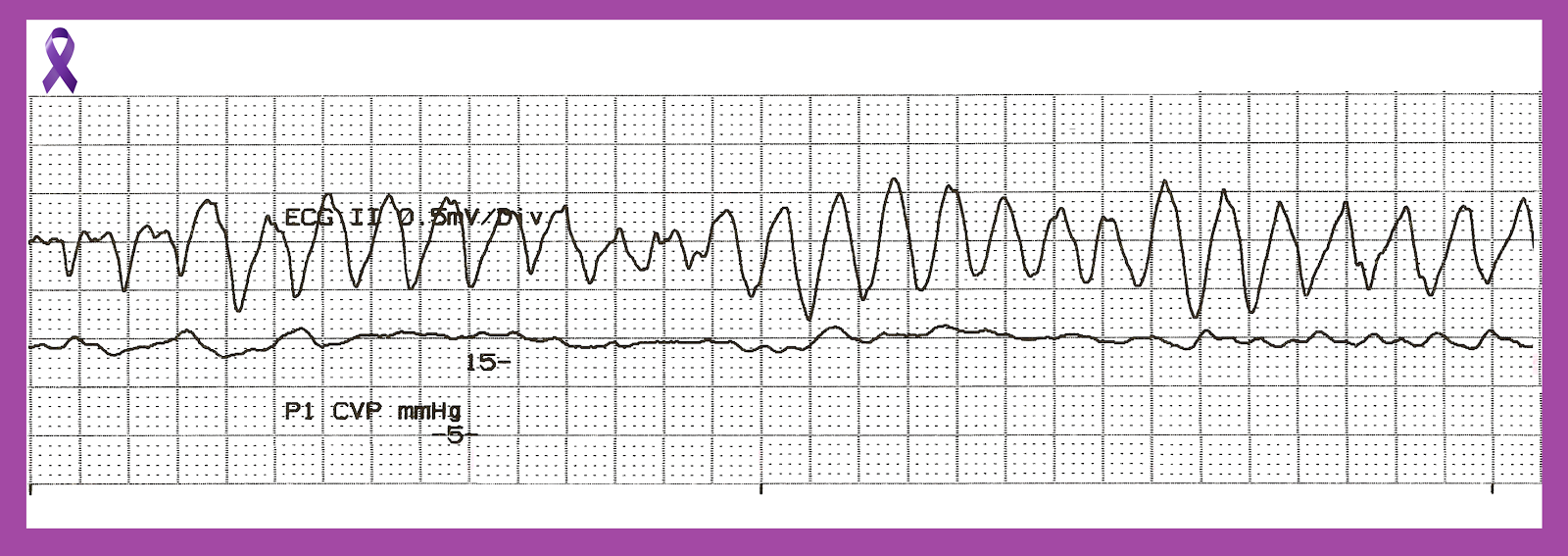 Float Nurse: Practice EKG Strips 361