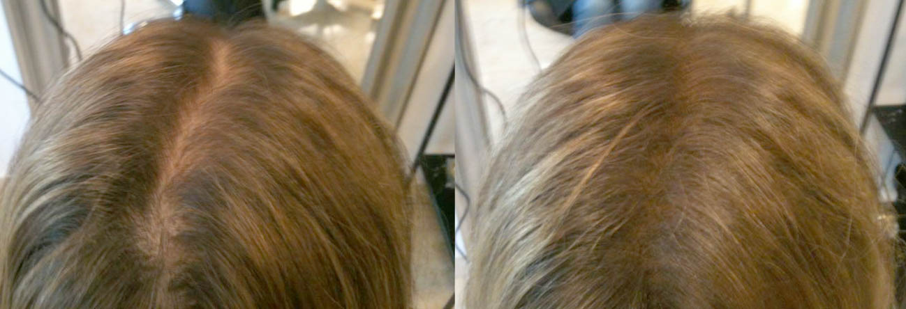 ¿Cirugía Plástica Capilar?