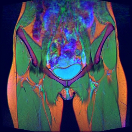 Nevit's blog: Coronal Color MRI of Female Pelvis