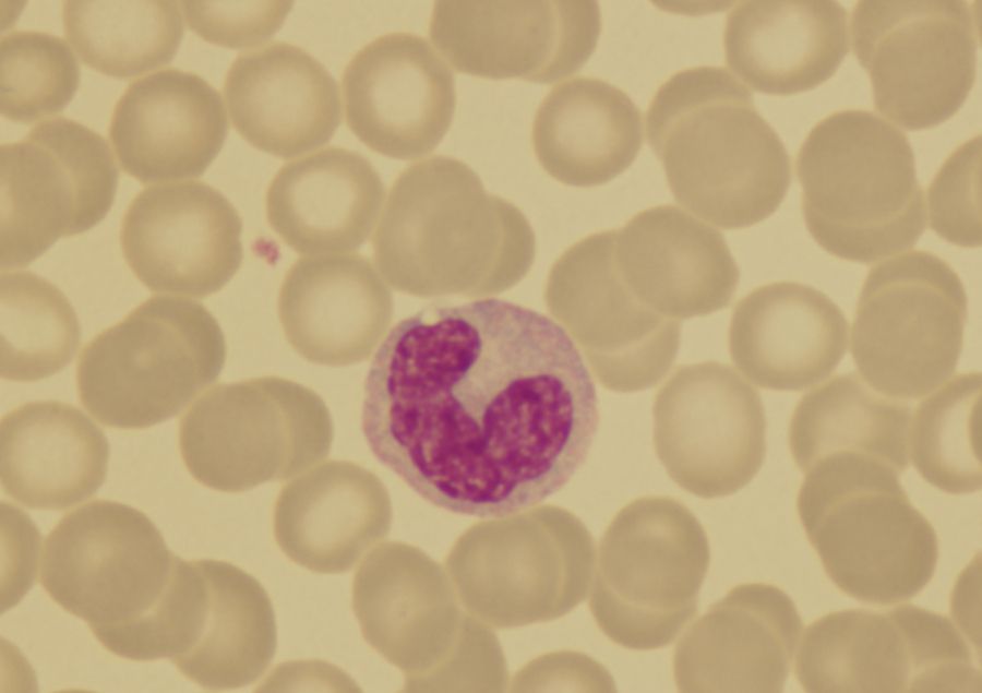 HEMATOLOGIA: PRACTICA 4: TINCION DE WRIGHT.