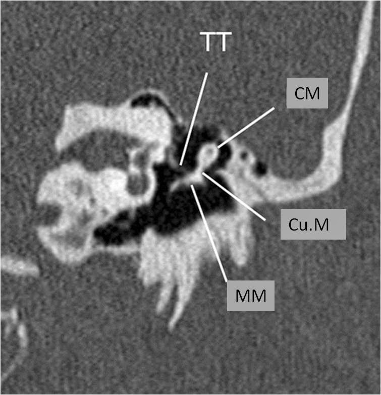 ESPE 202 - 2014: Anatomía y patología de oido