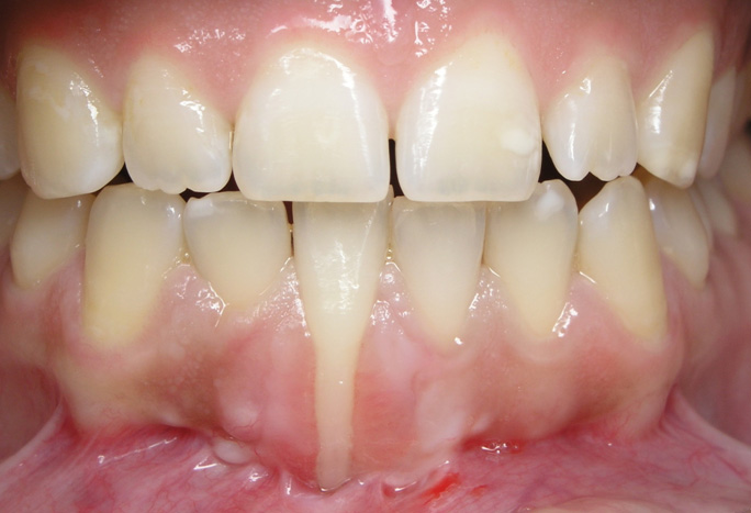 Deformutilation: Receding Gums