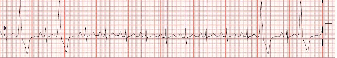 EKG Rhythm Strip Quiz 20