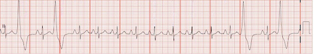 EKG Rhythm Strip Quiz 20