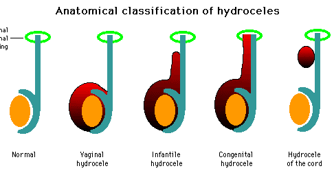 Hydrocele | Health Center