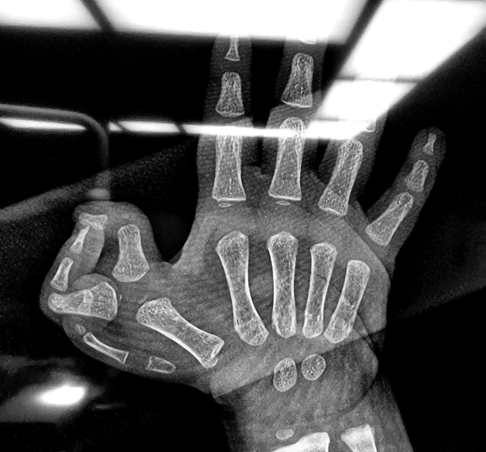 Three thumbs | Congenital Hand and Arm Differences | Washington ...