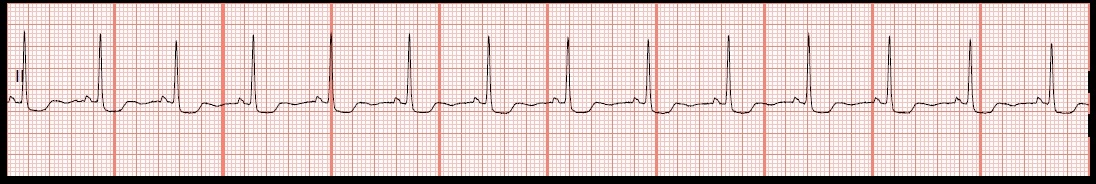 Practice EKG Rhythm Strips 160