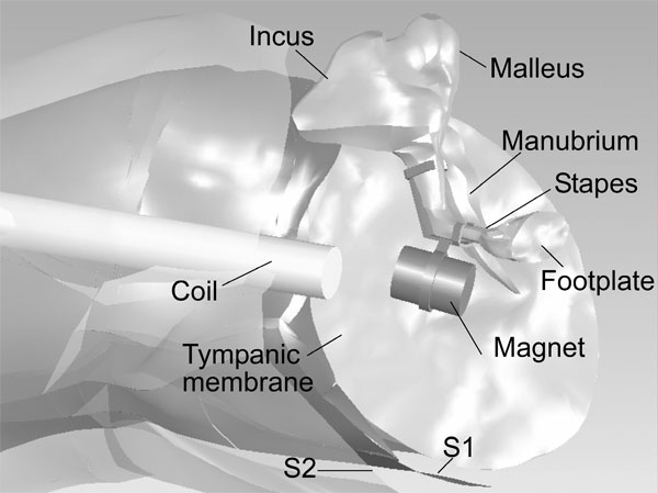 Hearing System is Totally Implantable