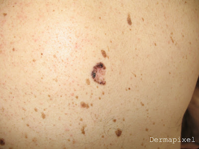 Dermapixel: febrero 2011