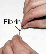 AREA 48. . : CLOTTING TIME FOR LUNG CANCER.