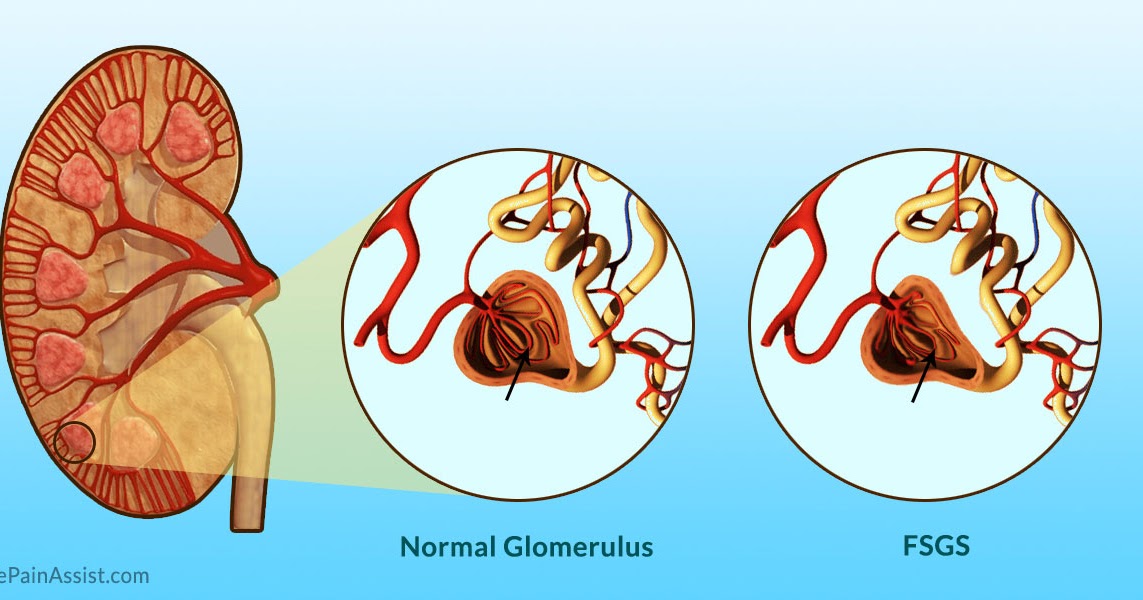 Renal-disease: Treatment options for FSGS patients with creatine level 5