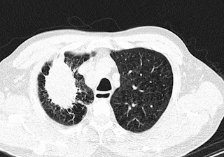 Ultimate Radiology : Case Of Ca Lung