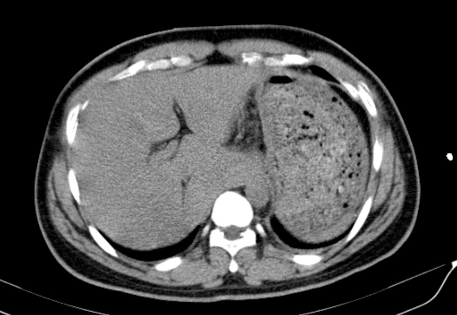 Ultimate Radiology : Active arterial extravasation in Blunt Abdominal ...