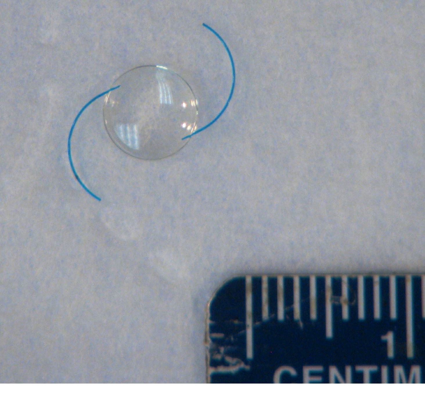 neuropathology blog: "Gross only" sign out of intraocular lens prosthesis