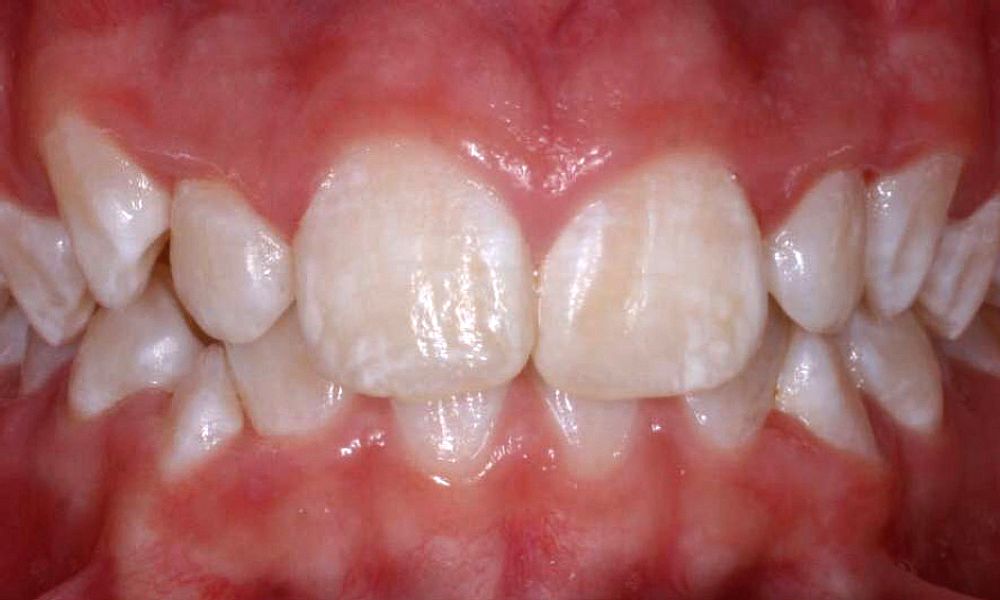Eleven Tips To Treat White Spots On Teeth Directorio Odontol gico eleven-tips-to-treat-white-spots-on-teeth-directorio-odontol-gico