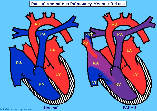 Ramblings and Rumblings: Tuesdays with Chandra: Pulmonary vein elopes