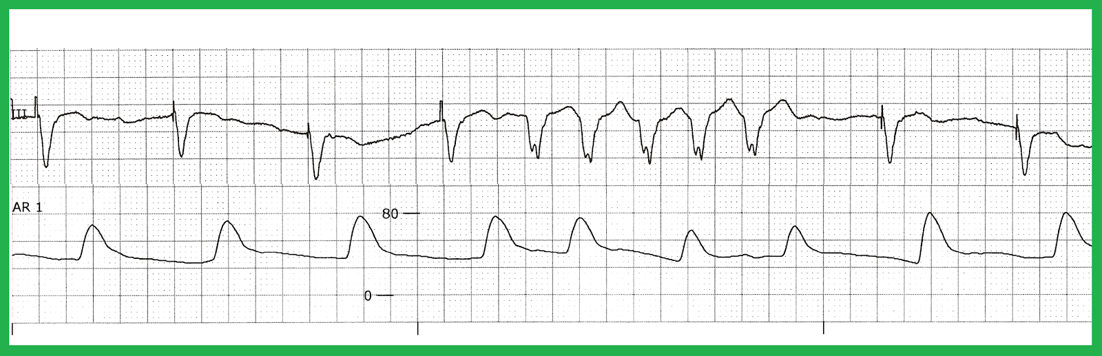 EKG Rhythm Quiz 230
