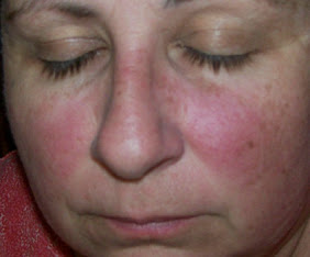 Scarlet Letters, dealing with vascular rosacea, face flushing, burning ...
