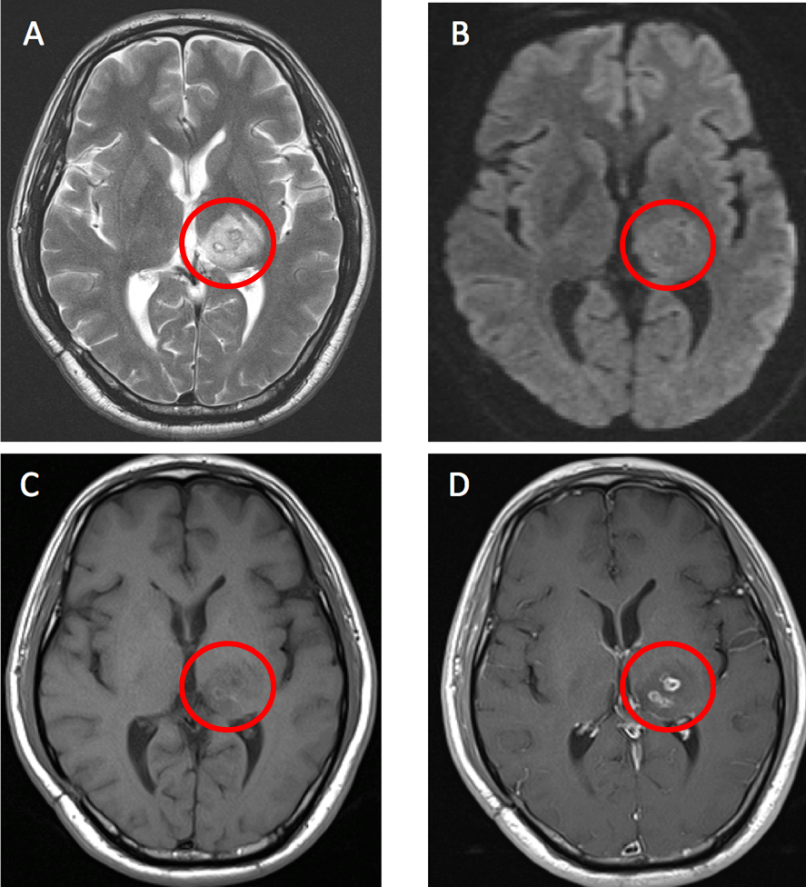 Imagine if you are hosting a brain parasite for 4 years