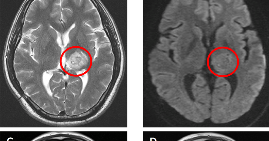 Imagine if you are hosting a brain parasite for 4 years