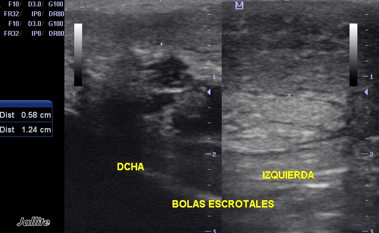 Engrosamiento Escrotal post Absceso