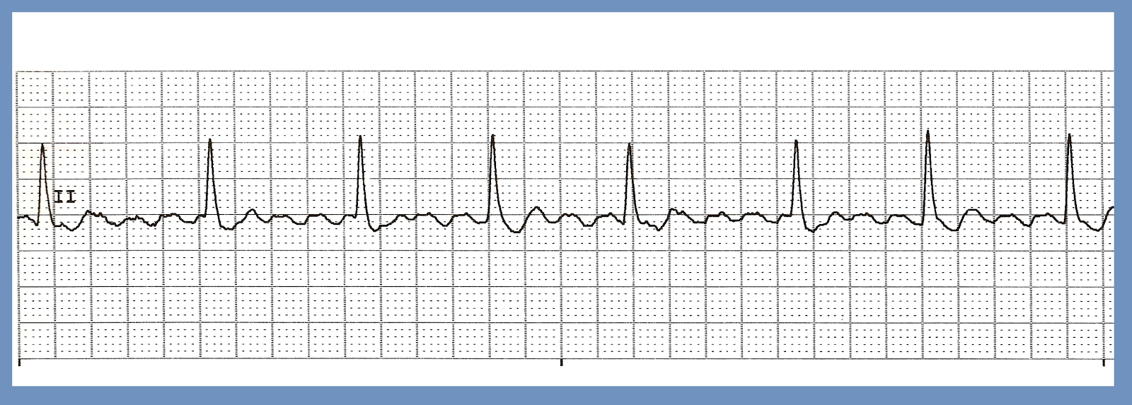 Basic EKG Rhythm Test 15
