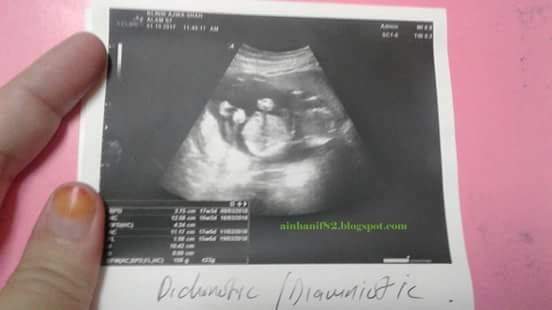 Kedai Vitamin Online Mommy Ain: My Twin Pregnancy Story Part 4 ~ Gambar ...