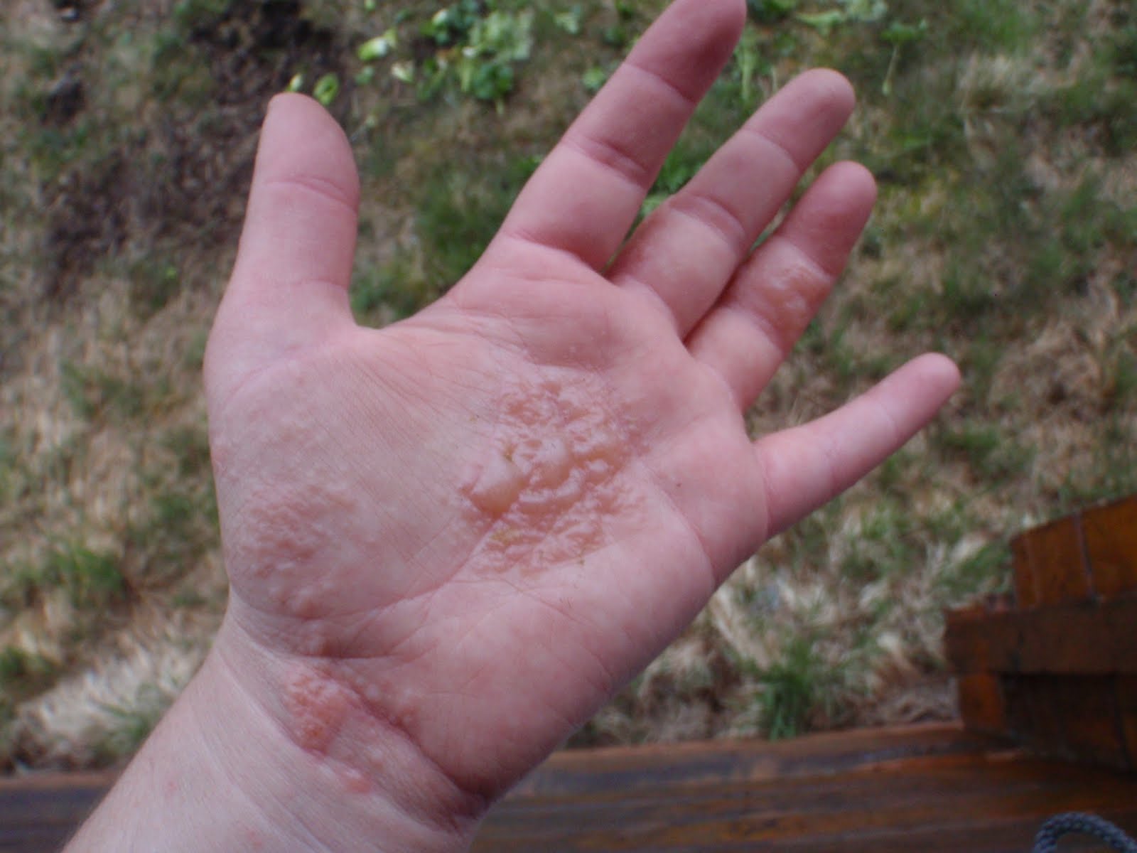 Fieldwork, Travel, and Food: Home early with bad pushki burns