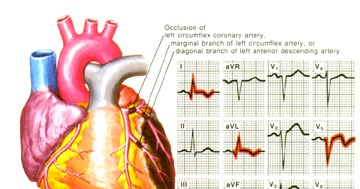 Lateral ST Elevation Myocardial Infarction | INA - ECG