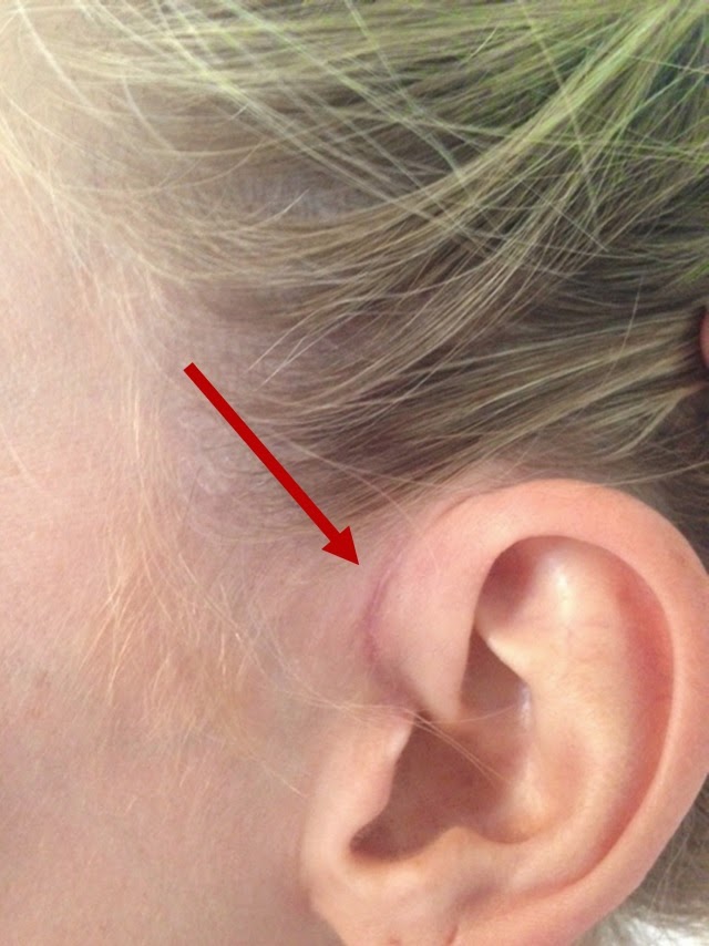 A smile is a curve that sets everything straight. :) [My Jaw Surgery ...