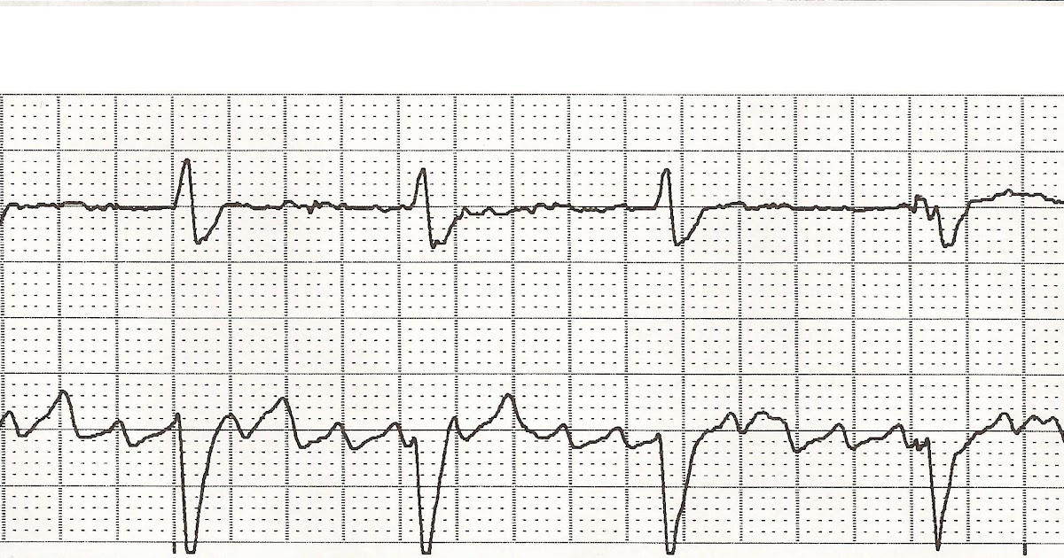 EKG Rhythm Strip Quiz 46