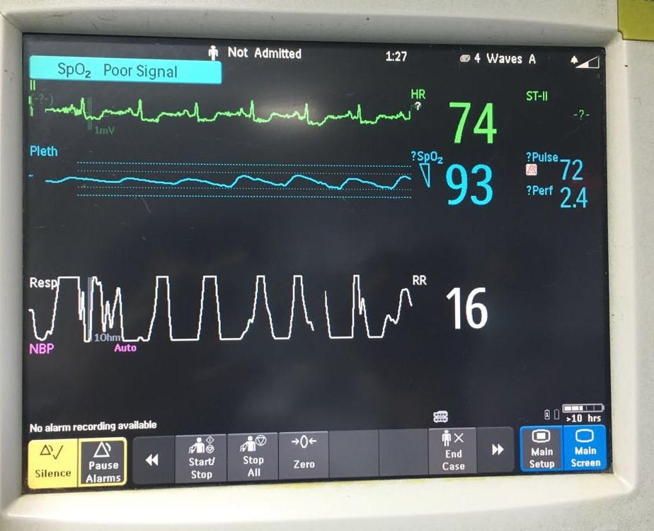 Identification of Pacemaker Rhythm In Cardiac Monitor ~ Materialnotes ...