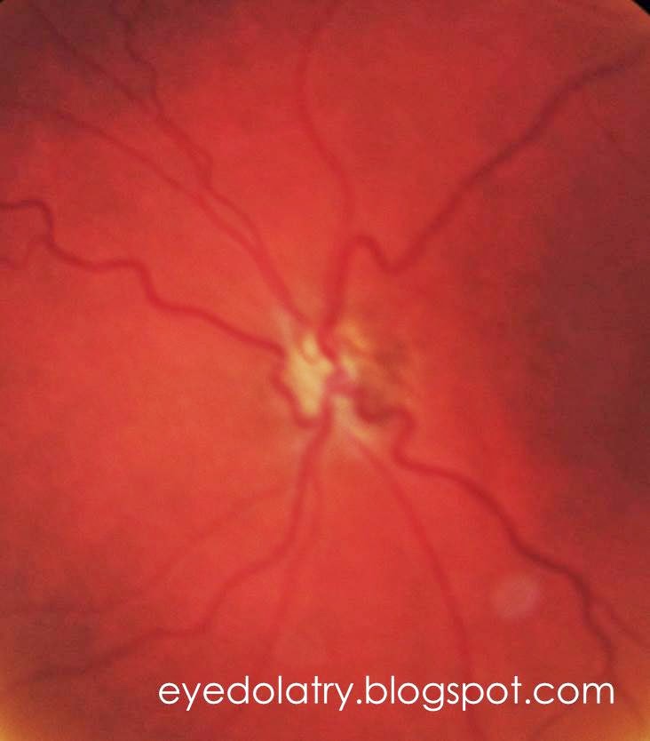 Retinal Photography Review: Hypoplastic Optic Nerve - Eyedolatry