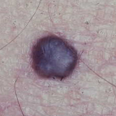 Reseñas en Dermatología: Nevus