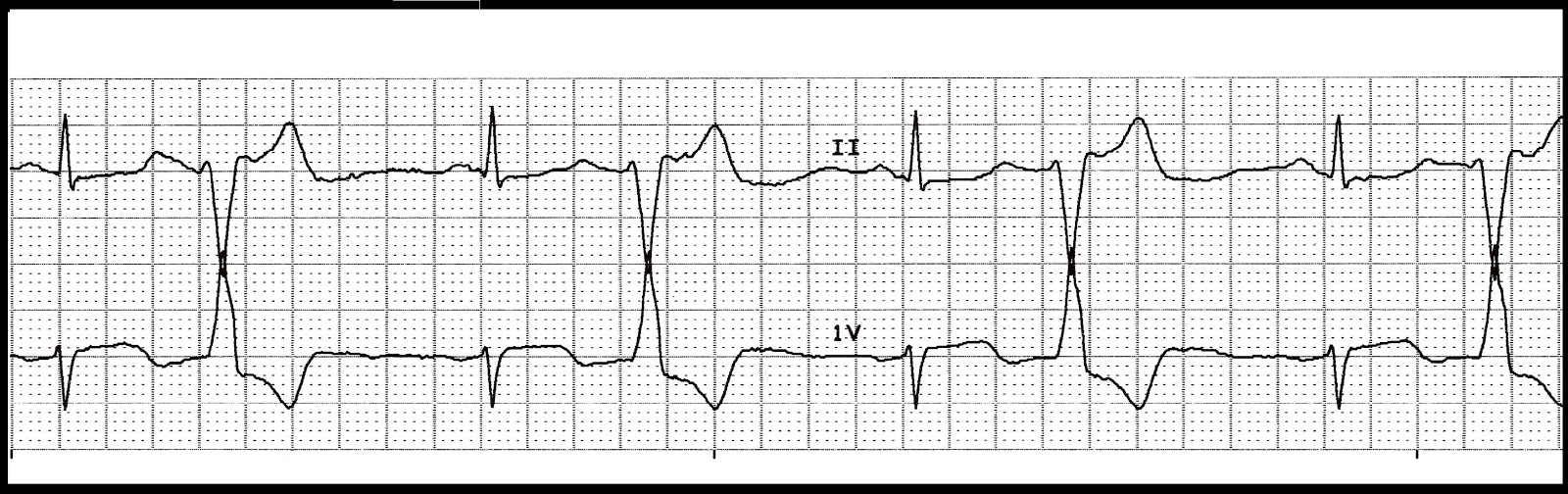 Basic EKG Rhythm Test 34