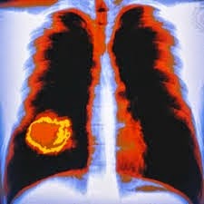 Cara Membersihkan Paru-Paru Akibat Rokok Tanpa Kemoterapi