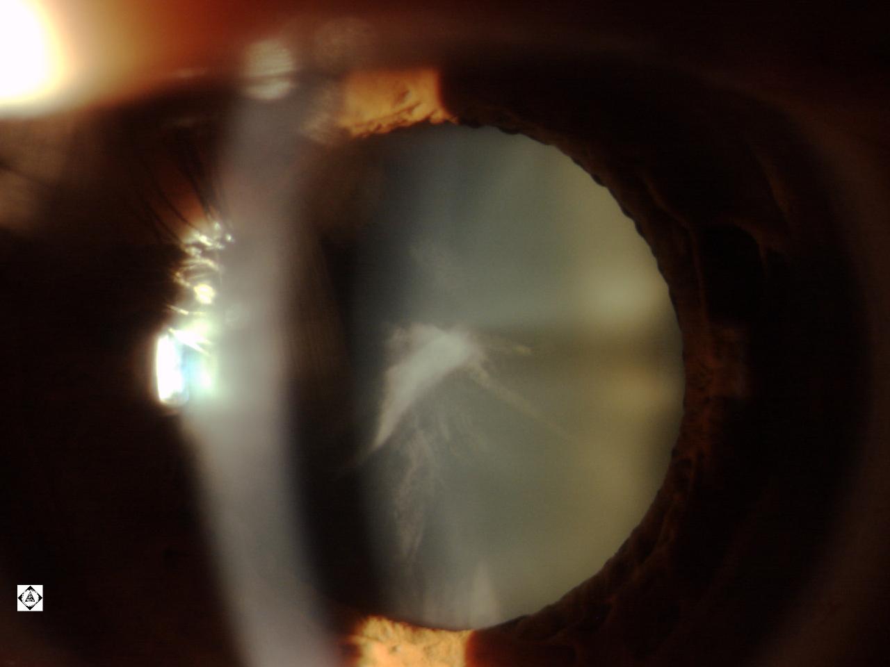 Sonoran Desert Eye Center: CORTICAL SPOKING CATARACTS