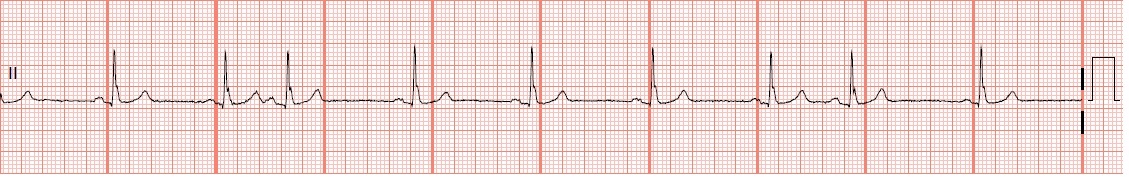 EKG Rhythm Strip Quiz 26
