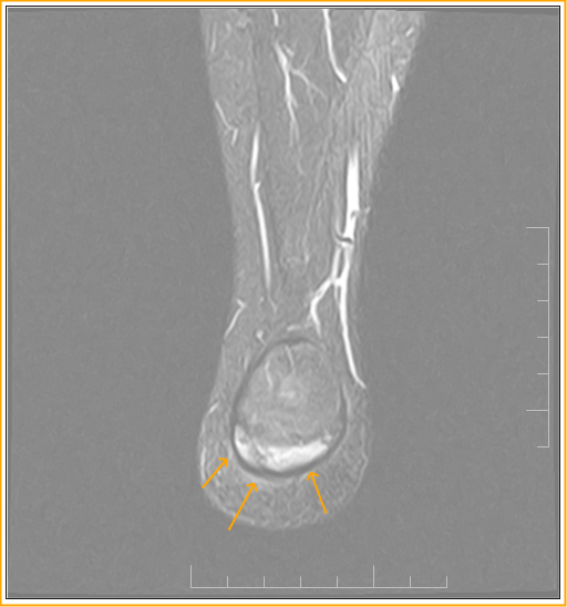 Calcaneal Apophysitis: Sever's Disease - Sumer's Radiology Blog