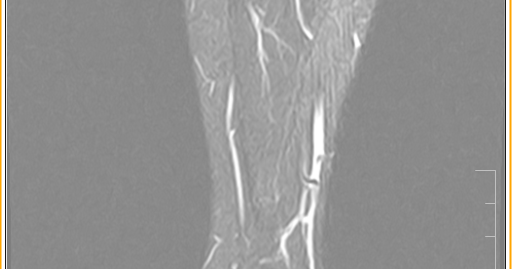 Calcaneal Apophysitis: Sever's Disease - Sumer's Radiology Blog