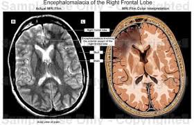 Easy Medical Terminology : Sunday Medical Terminology Word Encephalomalacia