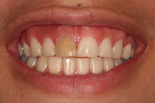 Karrie T. Chu, DDS: " Discolored Front Tooth" --- Internal bleaching