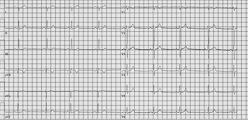 Axis QRS